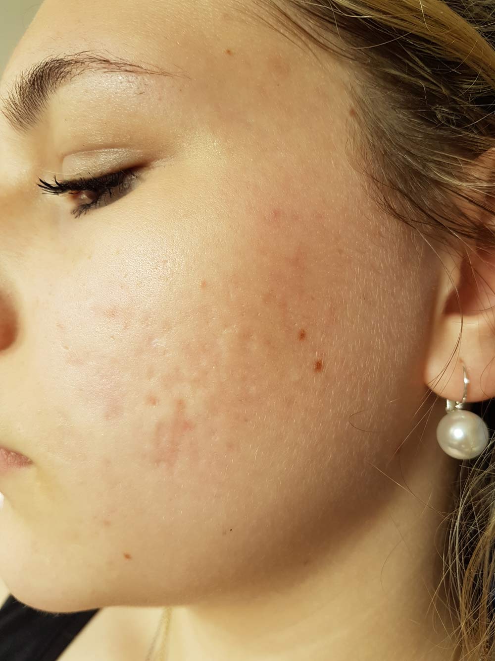 Akne-Behandlung in Hall in Tirol